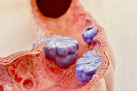 The Complete Guide to Colonoscopy: Preparation, Side Effects, and ...